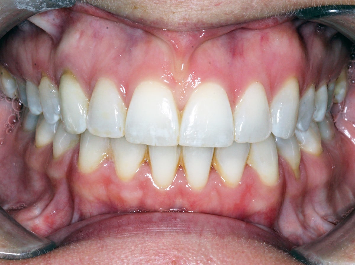 Virtual Smile Assessment - Bucks County Orthodontics