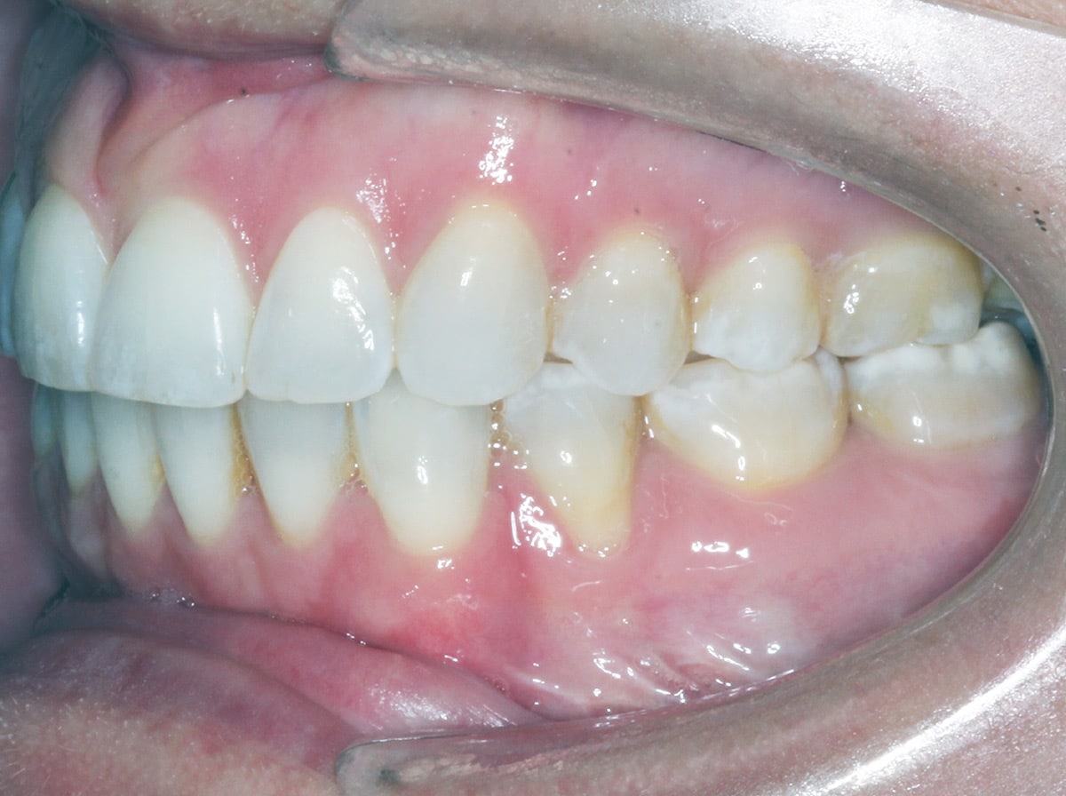 Virtual Smile Assessment - Bucks County Orthodontics